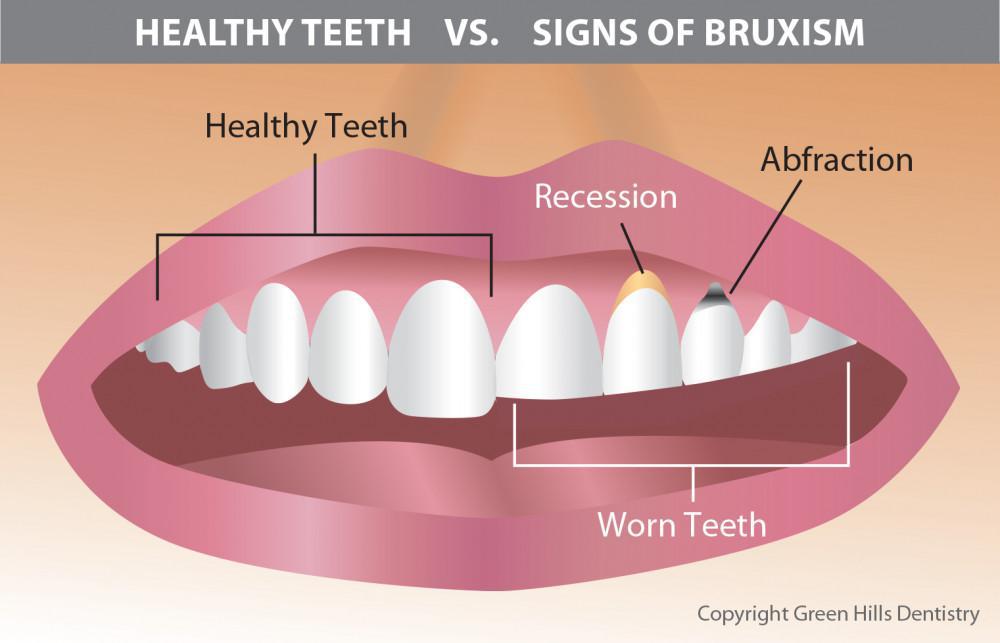Bruxism Teeth Grinding 